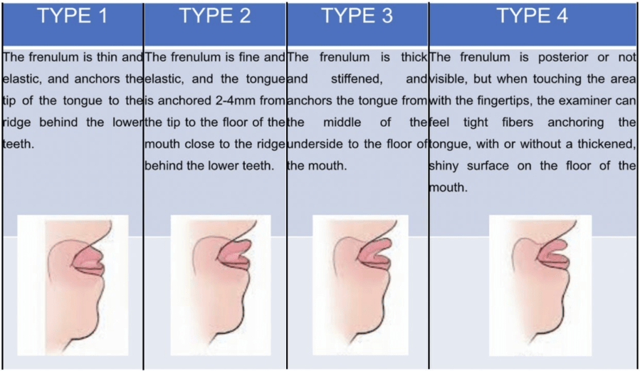Ankyloglossia: Causes, Symptoms, and Treatment Options – Arbona Health Hub