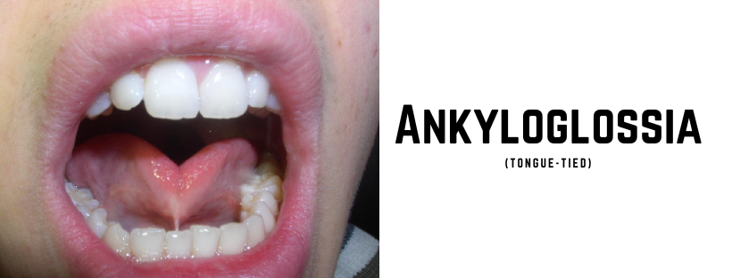Ankyloglossia: Causes, Symptoms, and Treatment Options – Arbona Health Hub
